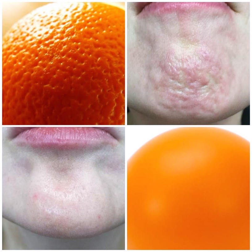 Botox For Neck Bands - Botox Brow Lift