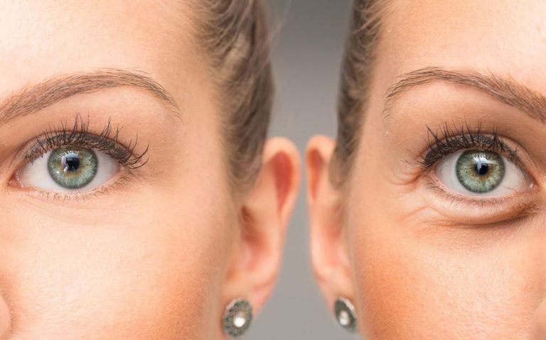 Botox Under Eyes: Smooth Under Eye Wrinkles with Botox - Botox Brow Lift