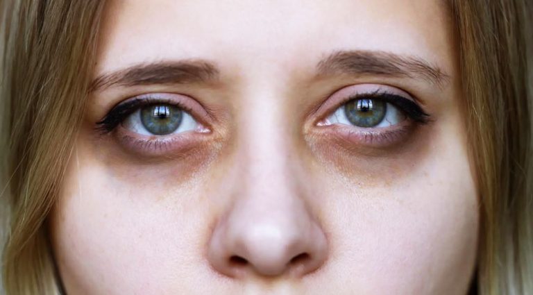 How to Say Goodbye to Sunken Eyes - Botox Brow Lift
